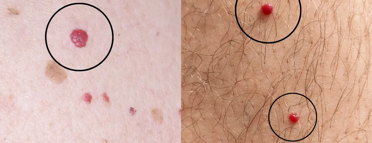 Descubre los diferentes tipos de angiomas en adultos y cómo tratarlos ...