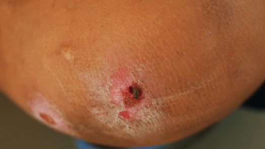 Descubre los diferentes tipos de costras en heridas y cómo cuidarlas ...