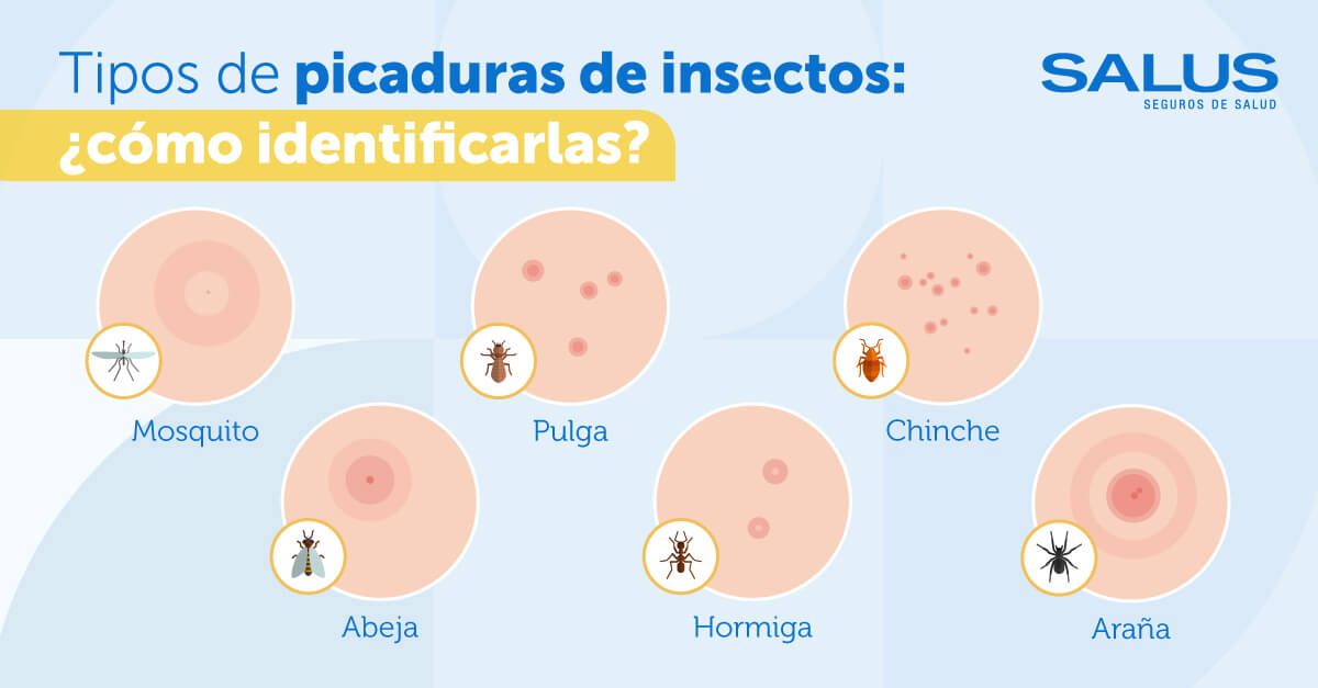 Diferentes tipos de picaduras: cómo identificarlas y tratarlas ...