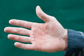 Guía completa: Los diferentes tipos de callos en las manos y cómo ...